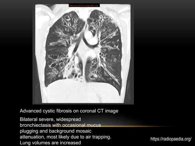 Paediatric chest imaging | PPTX | Lung and Respiratory Health ...