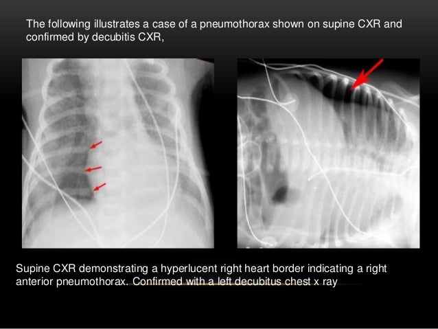 Infant Pneumothorax X Ray Tension Pneumothorax In Child With Mild