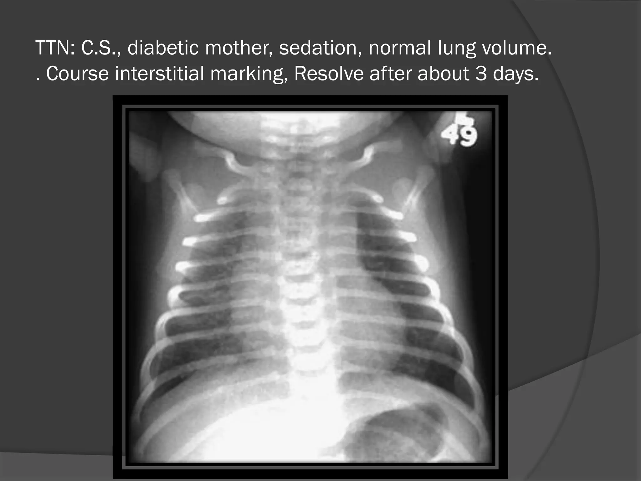 Paediatric chest imaging | PDF