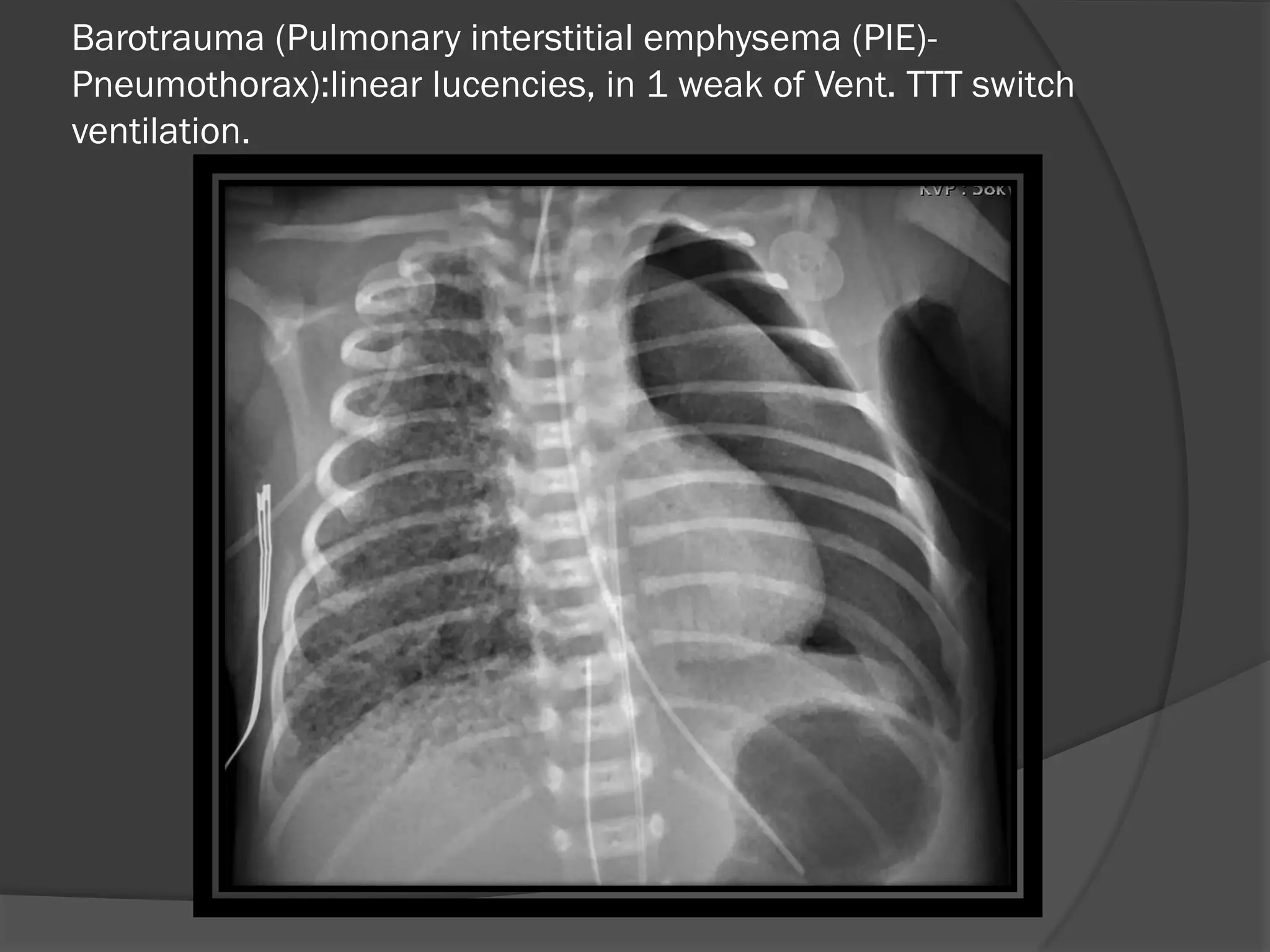 Paediatric chest imaging | PDF