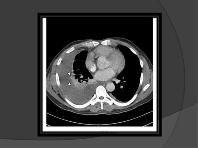 Paediatric chest imaging | PDF | Lung and Respiratory Health | Diseases ...
