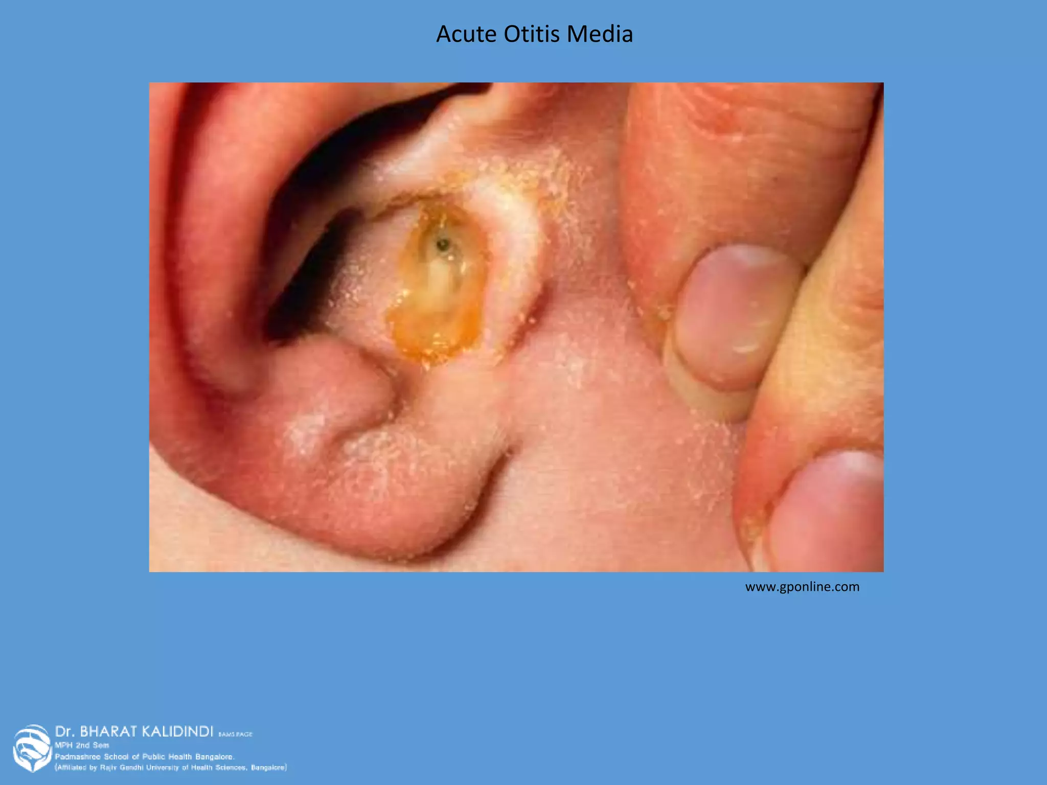 Paediatric Infectious diseases | PPTX