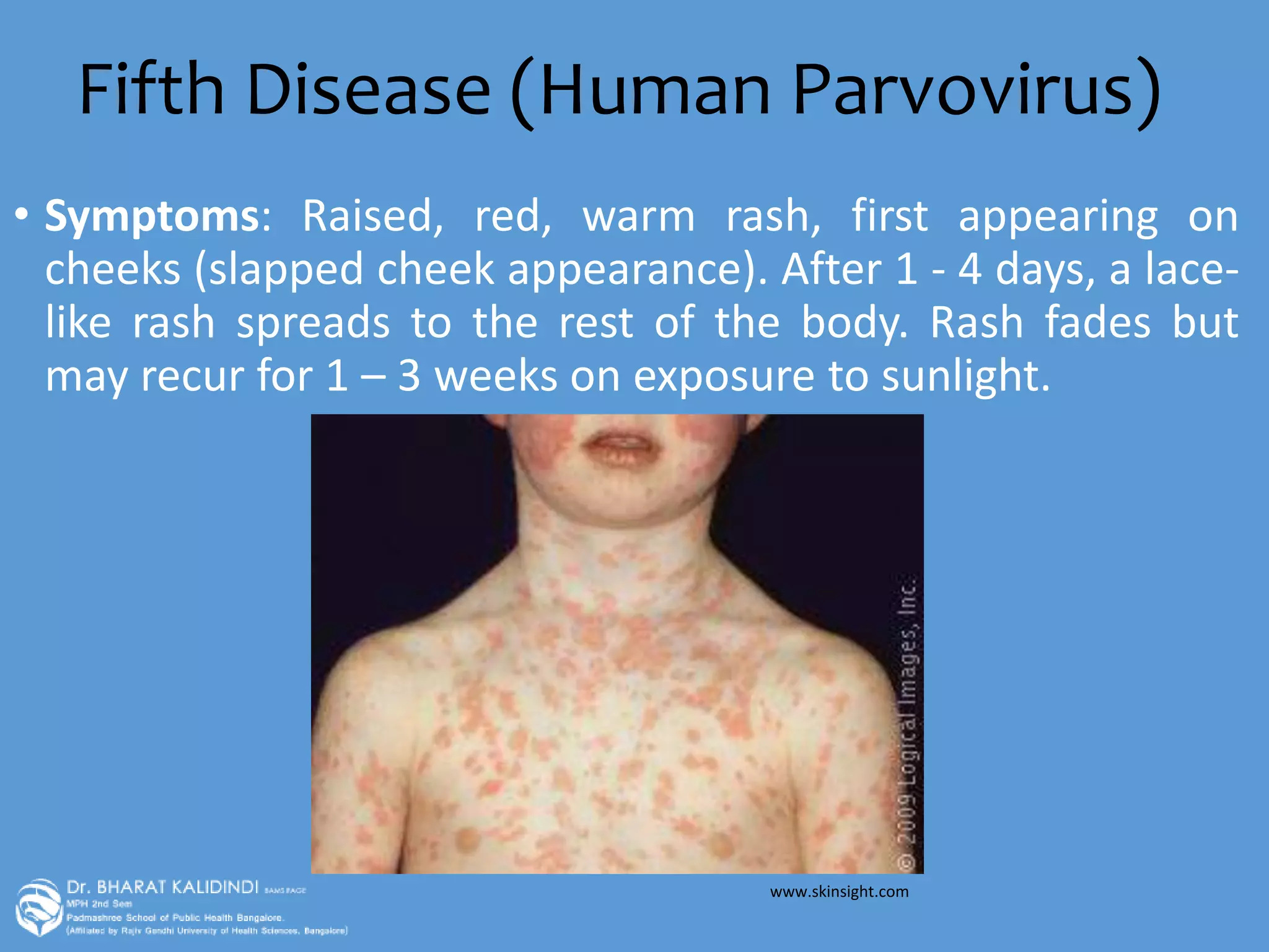 Paediatric Infectious diseases | PPTX