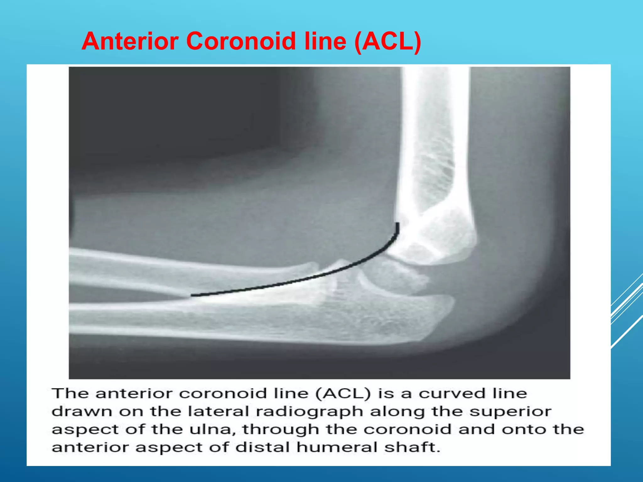 Radiographic evaluation of Paediatric elbow injury | PPTX