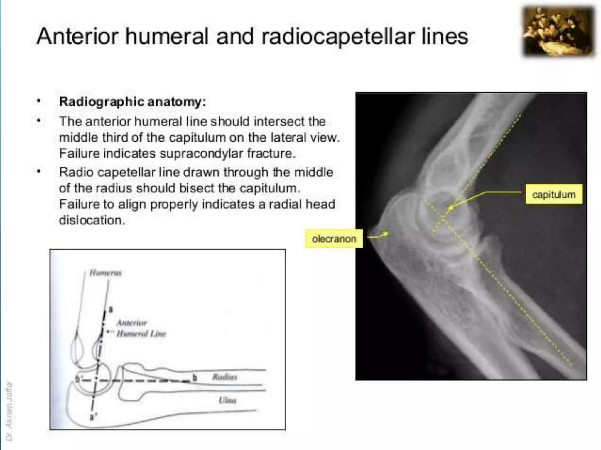 Radiographic evaluation of Paediatric elbow injury | PPTX