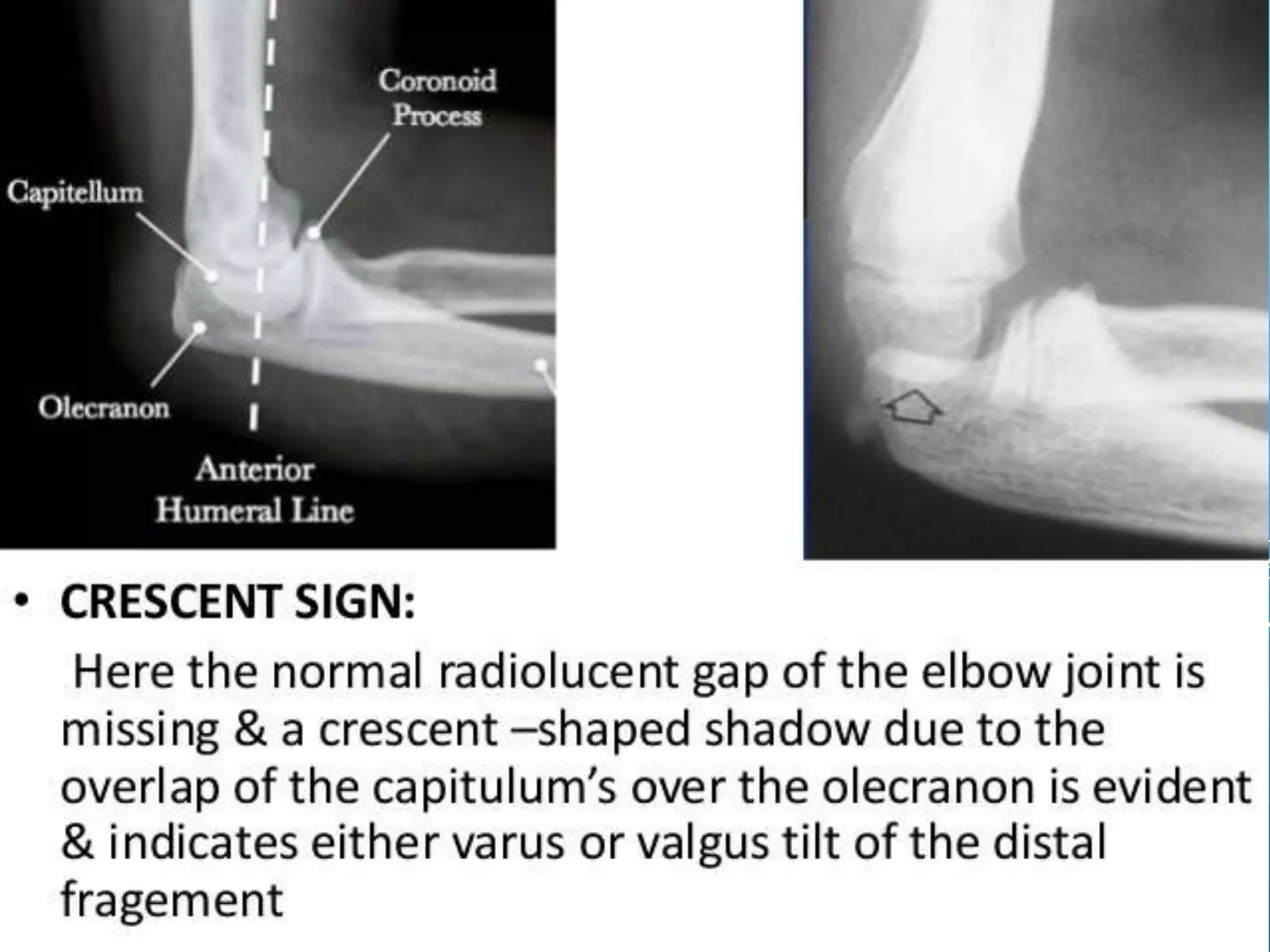 Radiographic evaluation of Paediatric elbow injury | PPTX