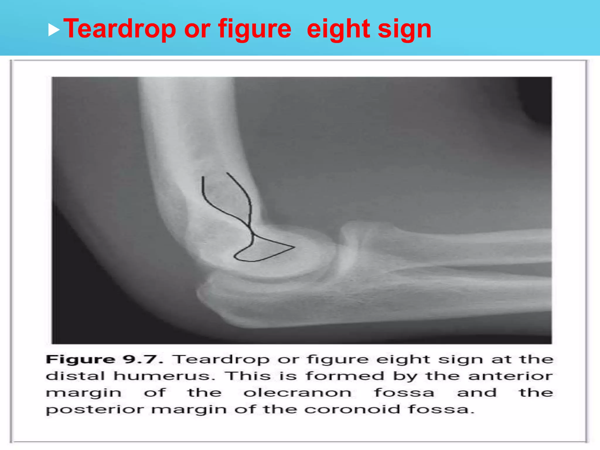 Radiographic evaluation of Paediatric elbow injury | PPTX