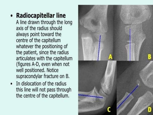 Radiographic evaluation of Paediatric elbow injury | PPTX