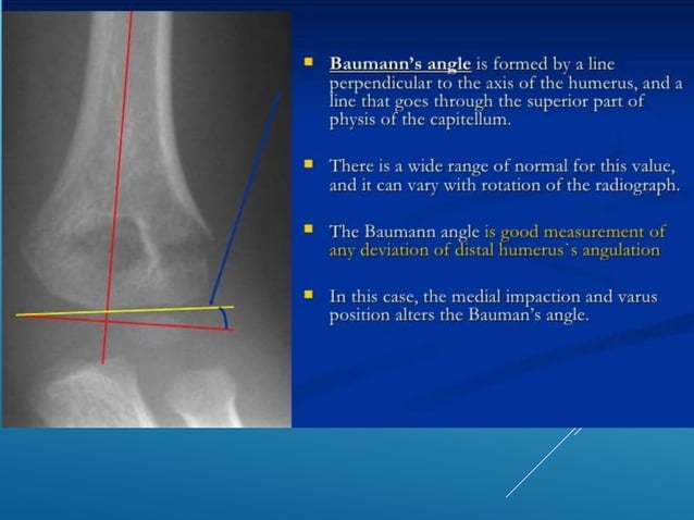 Radiographic evaluation of Paediatric elbow injury | PPTX