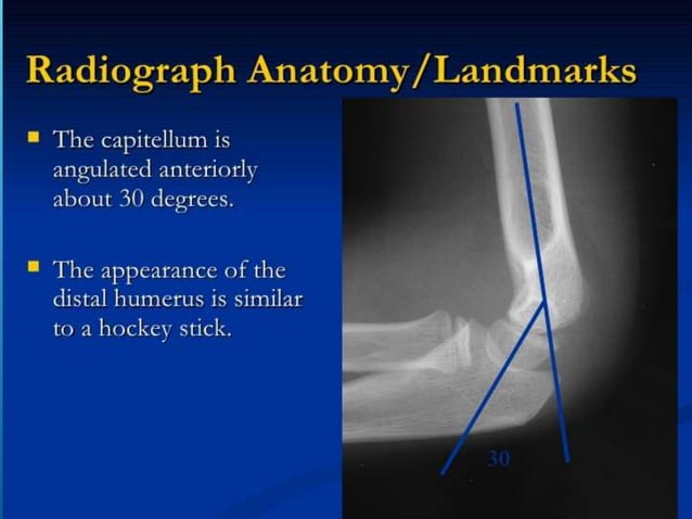 Radiographic evaluation of Paediatric elbow injury | PPTX