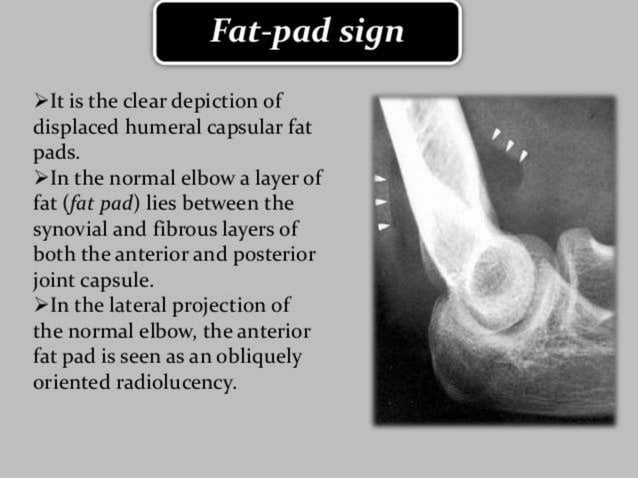 Radiographic evaluation of Paediatric elbow injury | PPTX