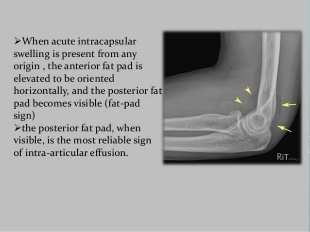 Radiographic evaluation of Paediatric elbow injury | PPTX