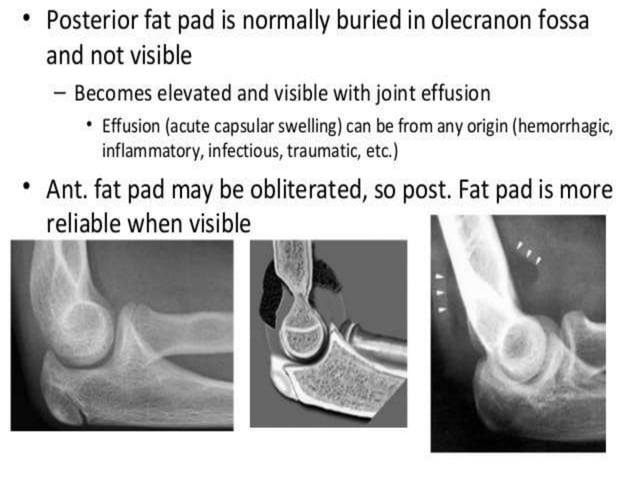 Radiographic evaluation of Paediatric elbow injury | PPTX