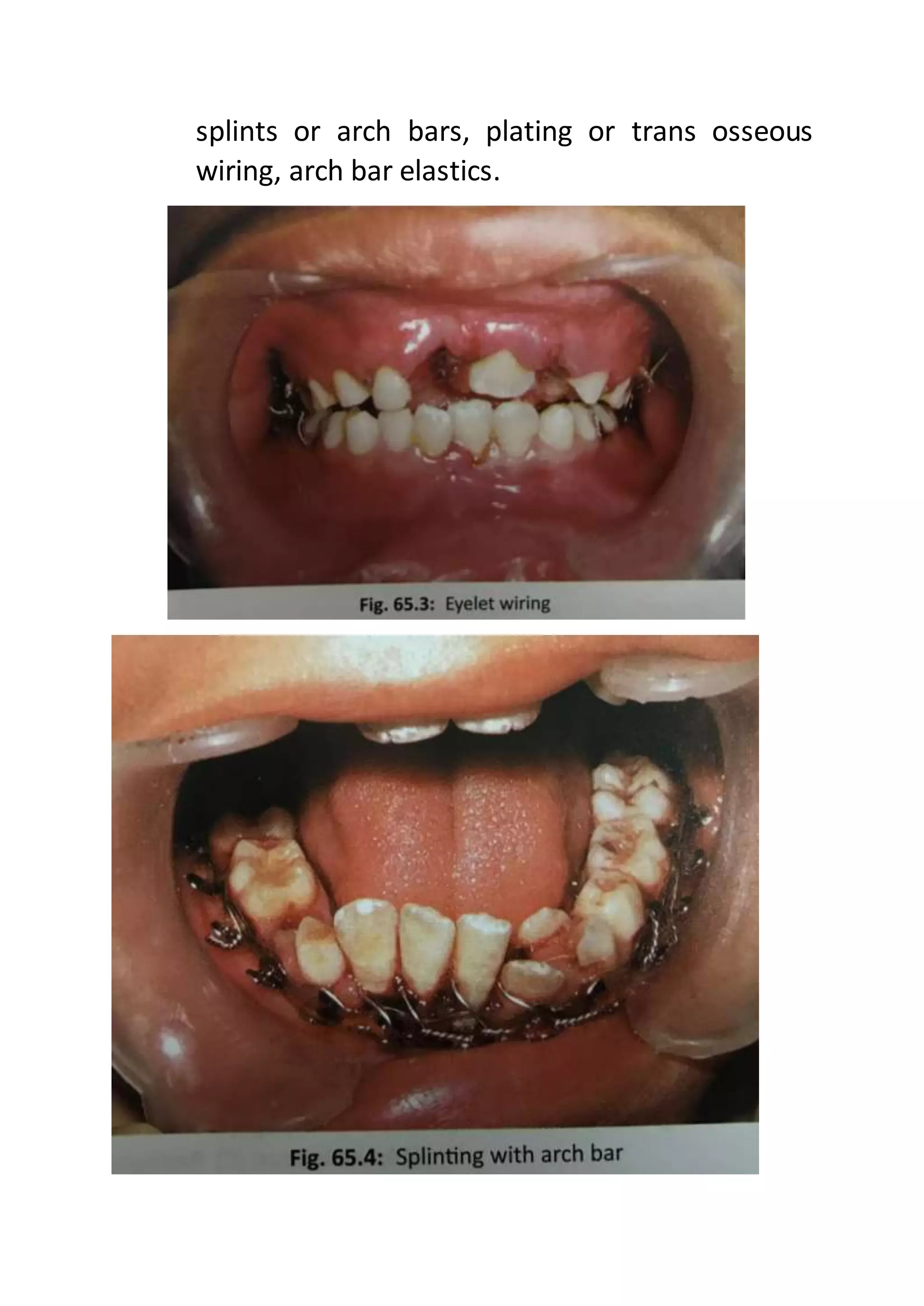 Paediatric Facial Fractures | DOCX
