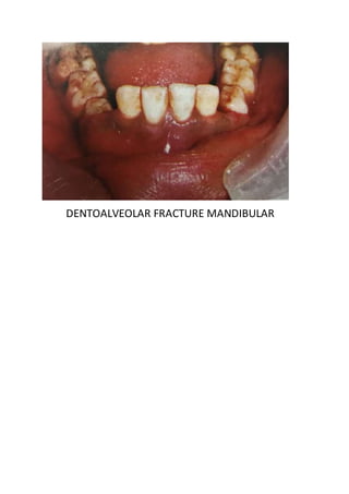 Paediatric Facial Fractures | DOCX