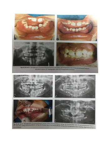 Paediatric Facial Fractures | DOCX