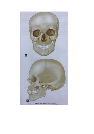 Paediatric Facial Fractures | DOCX