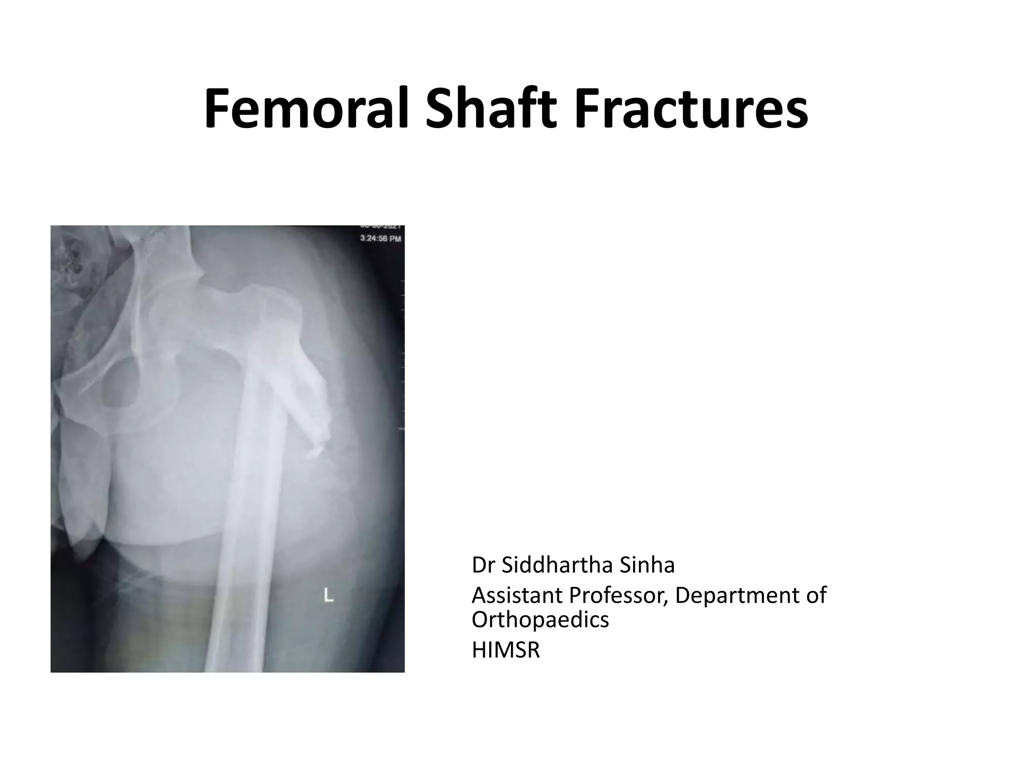 Femoral shaft fractures (Paedatric and adult) | PPTX