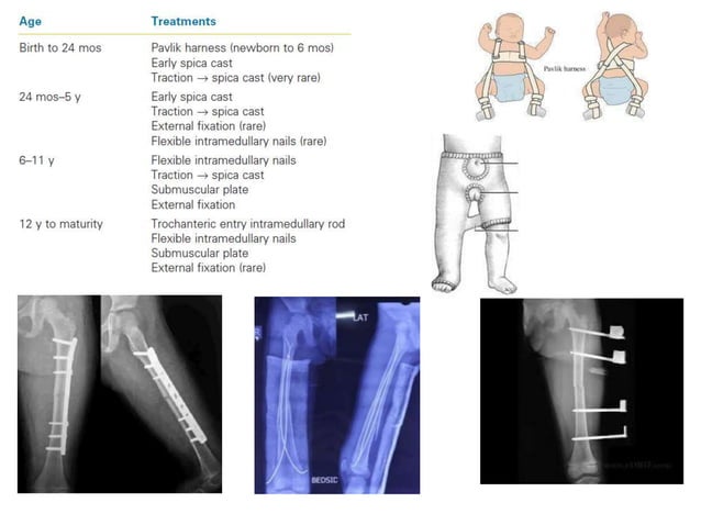 Femoral shaft fractures (Paedatric and adult) | PPTX