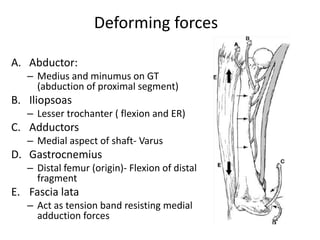 Femoral shaft fractures (Paedatric and adult) | PPT