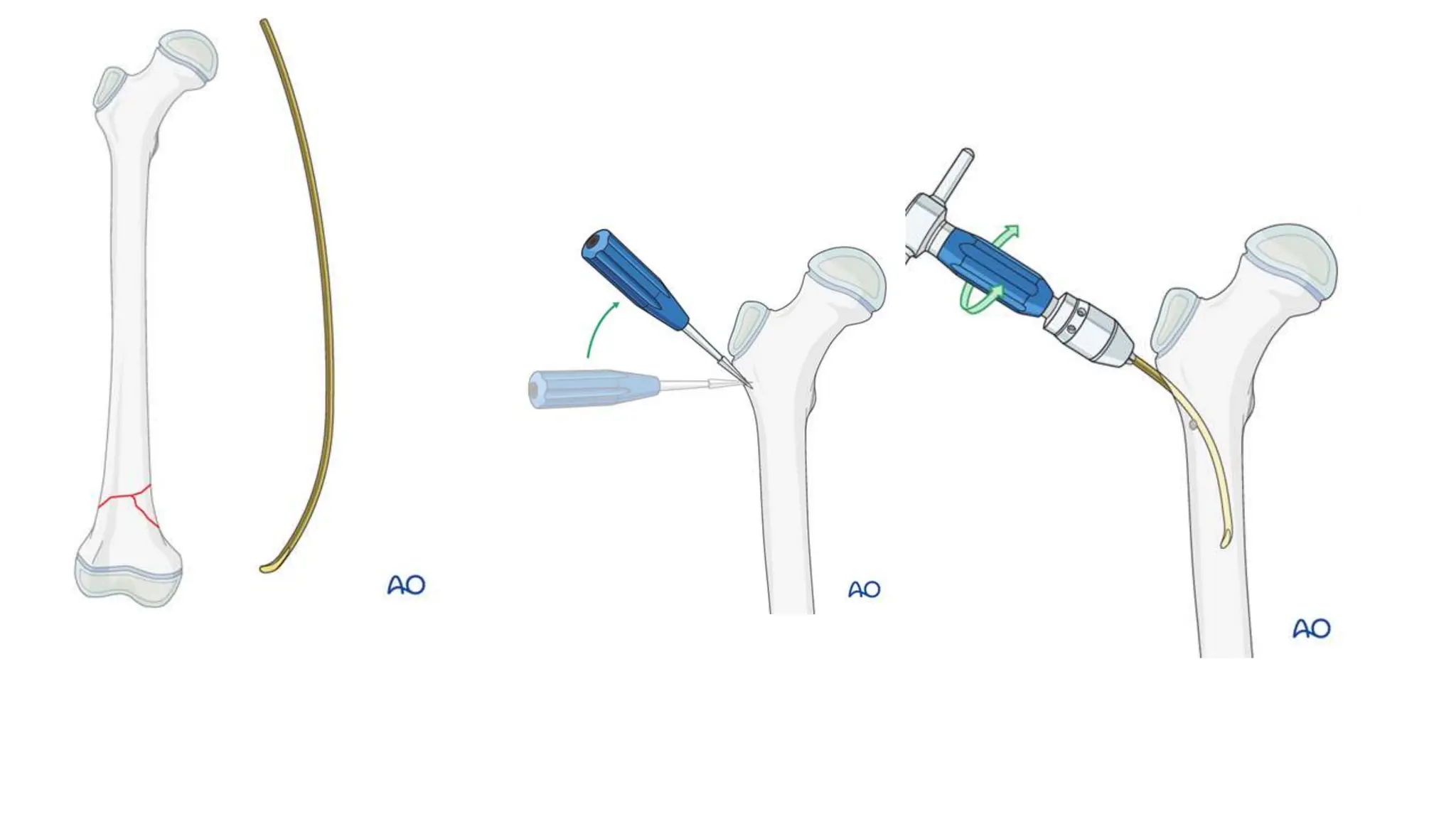 Paediatric femur fracture in preschool children.pptx