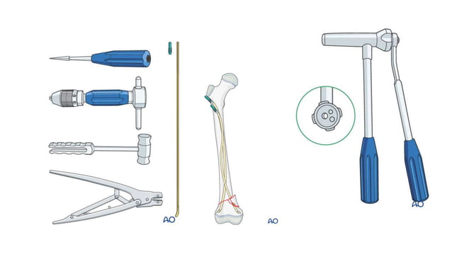 Paediatric femur fracture in preschool children.pptx