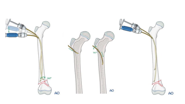 Paediatric femur fracture in preschool children.pptx