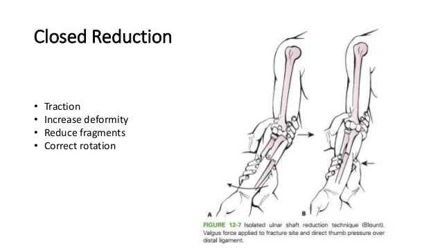 Paediatric Forearm Diaphysial Fractures