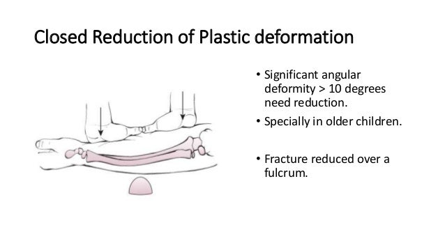 Paediatric Forearm Diaphysial Fractures