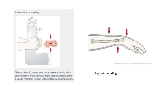 Paediatric Forearm Diaphysial Fractures