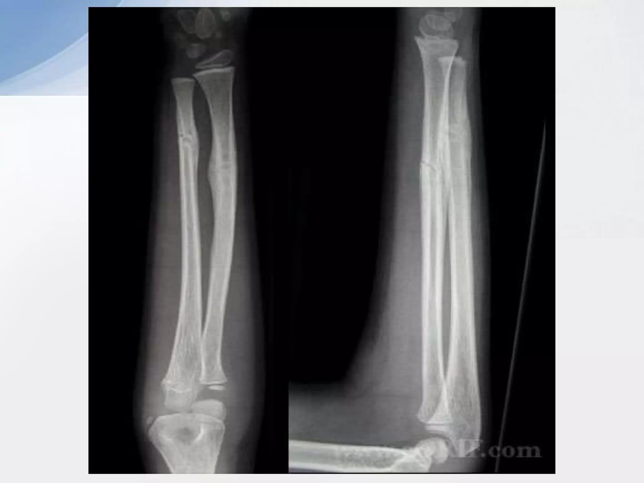 Paediatric forearm fractures | PPTX