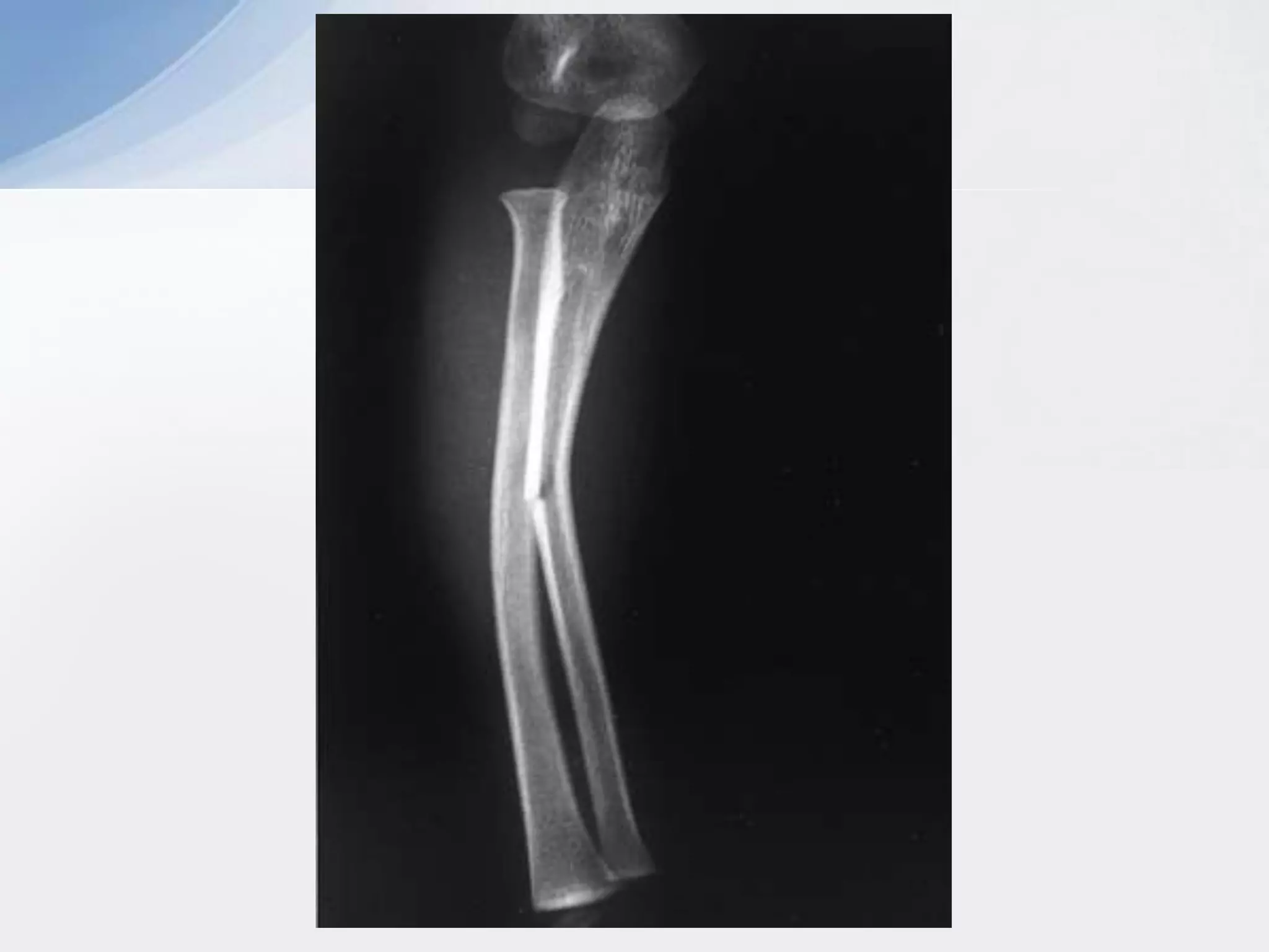 Paediatric forearm fractures | PPTX