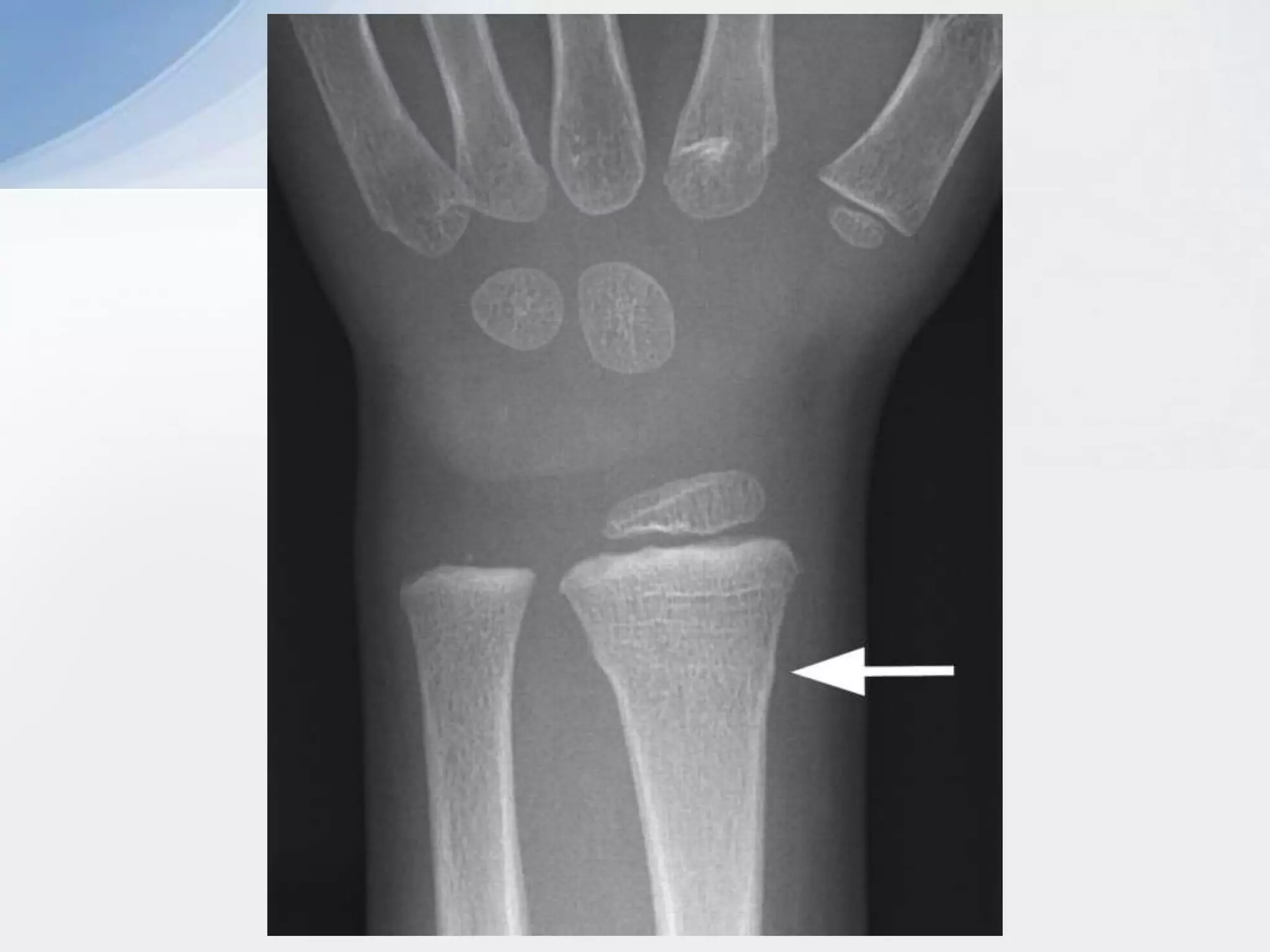 Paediatric forearm fractures | PPTX