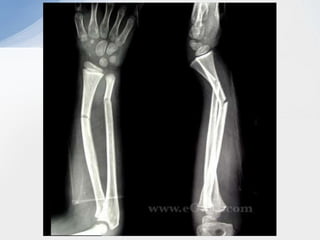 Paediatric forearm fractures | PPTX