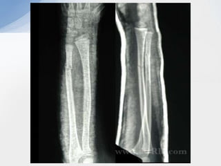 Paediatric forearm fractures | PPTX
