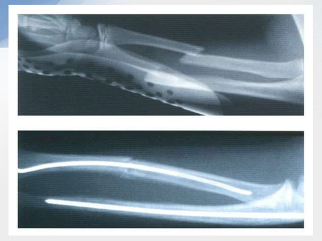 Paediatric forearm fractures | PPTX