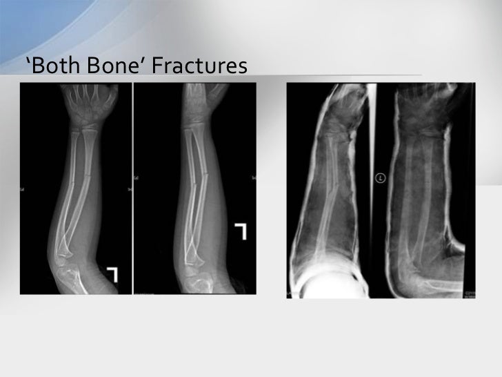 Paediatric forearm fractures