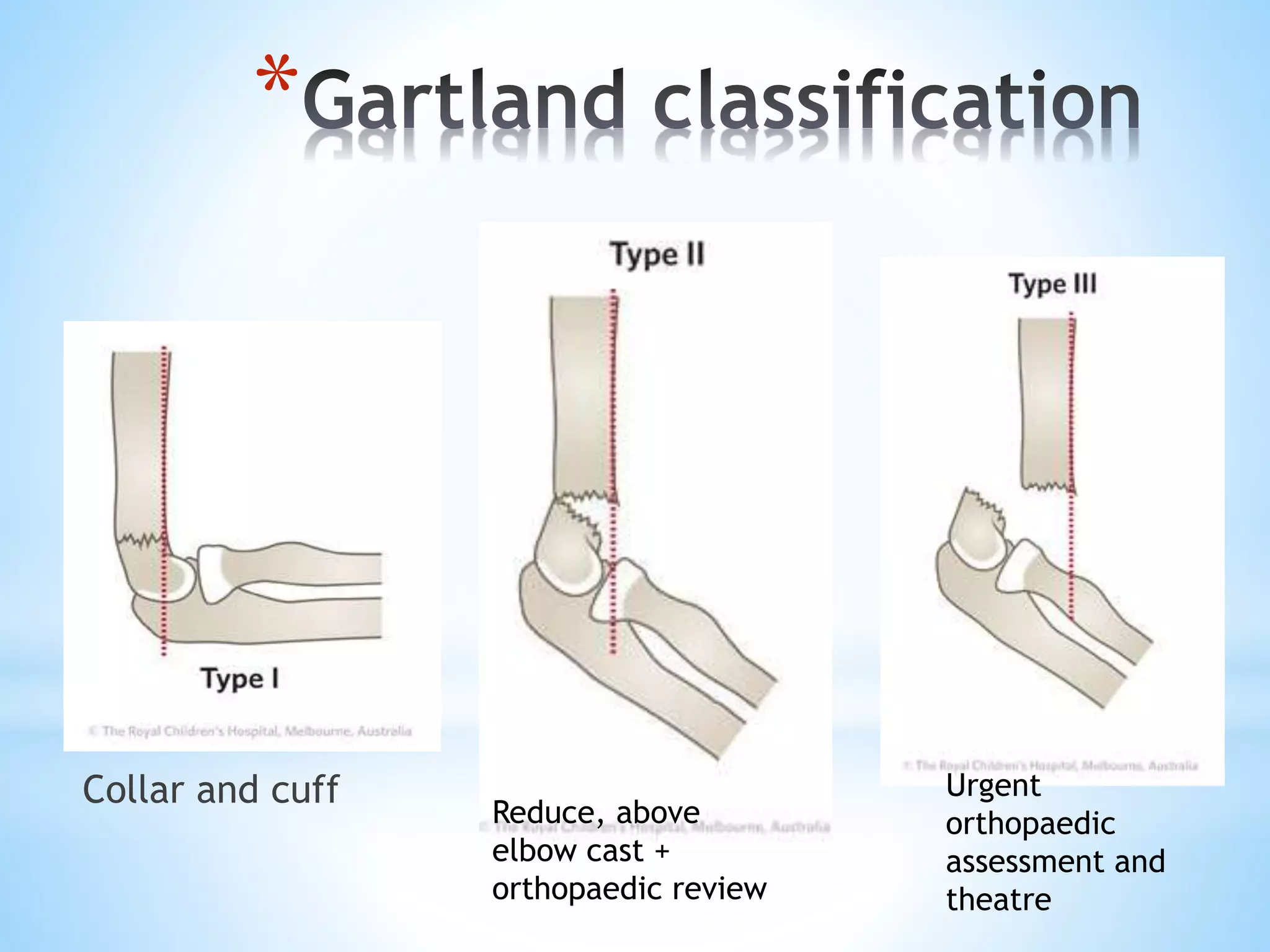Paediatric Fractures | PPTX