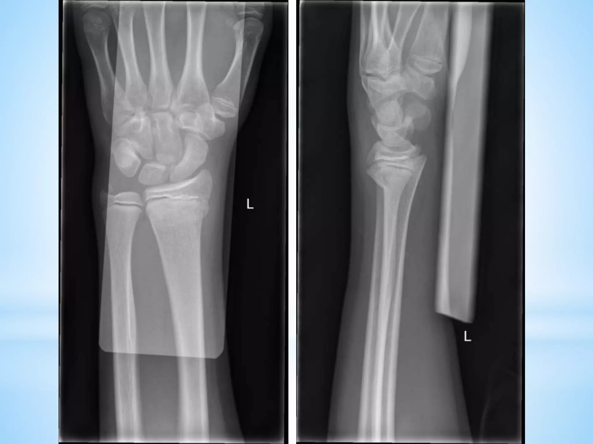 Paediatric Fractures | PPTX