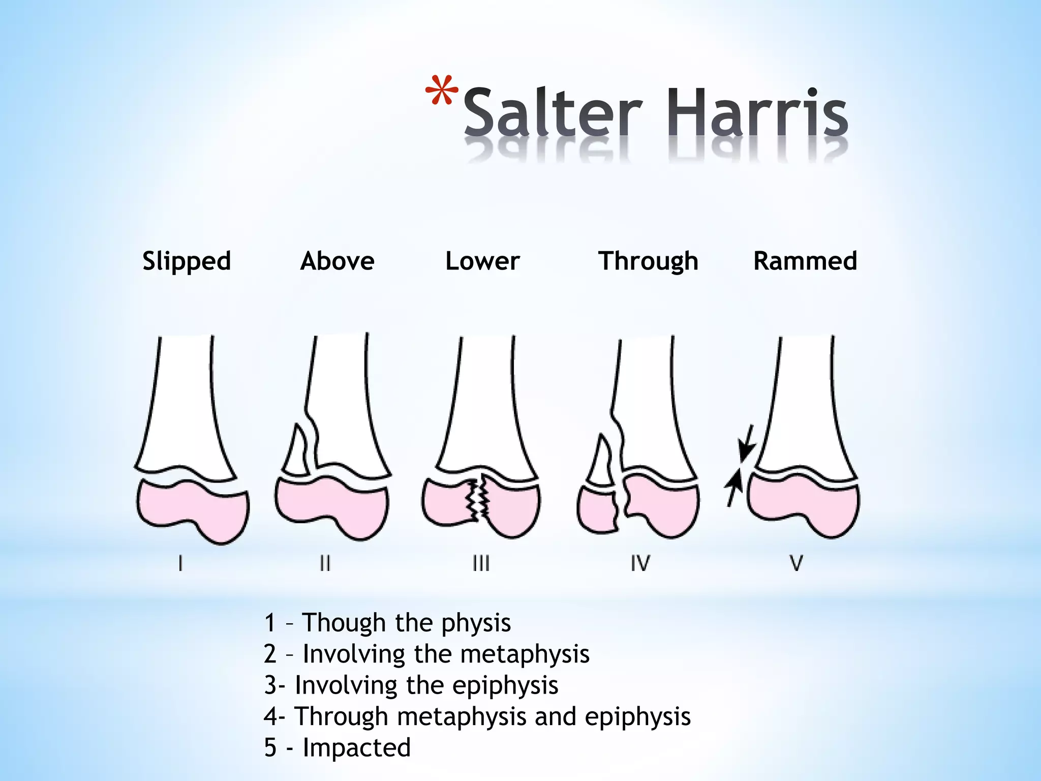 Paediatric Fractures | PPTX