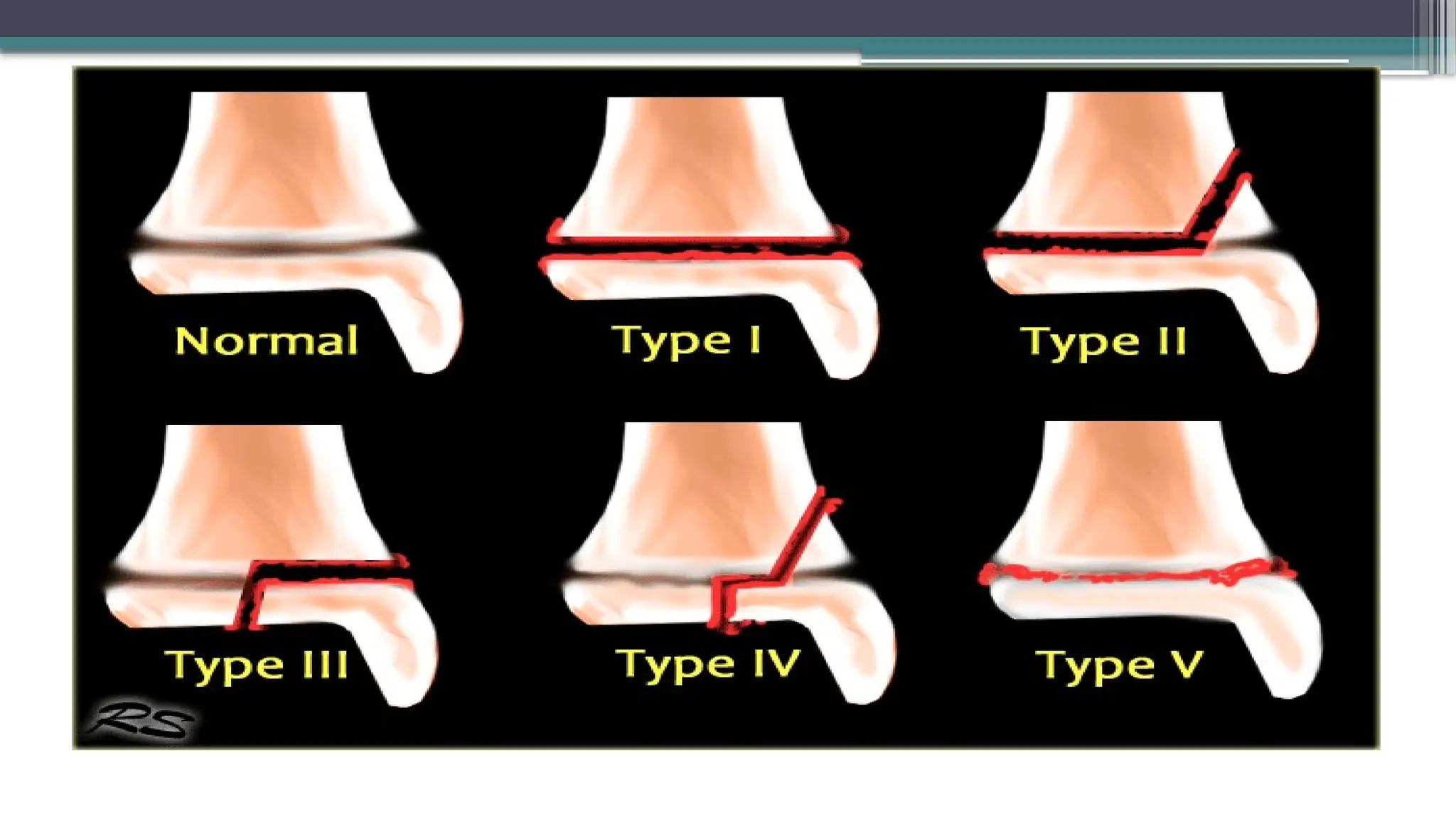Paediatric Fractures and Management.pptx