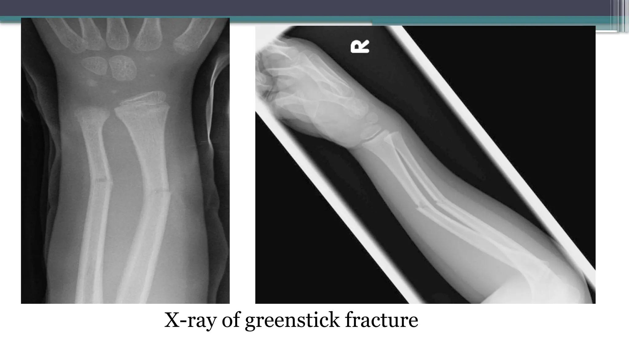 Paediatric Fractures and Management.pptx
