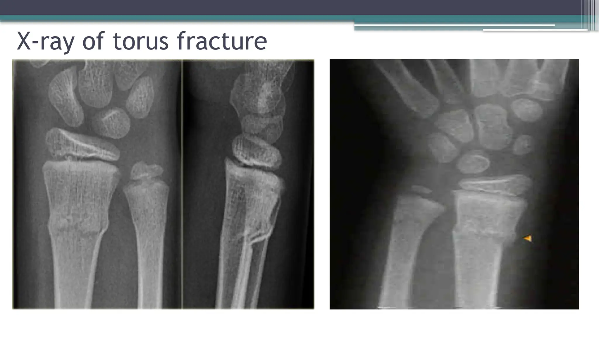 Paediatric Fractures and Management.pptx