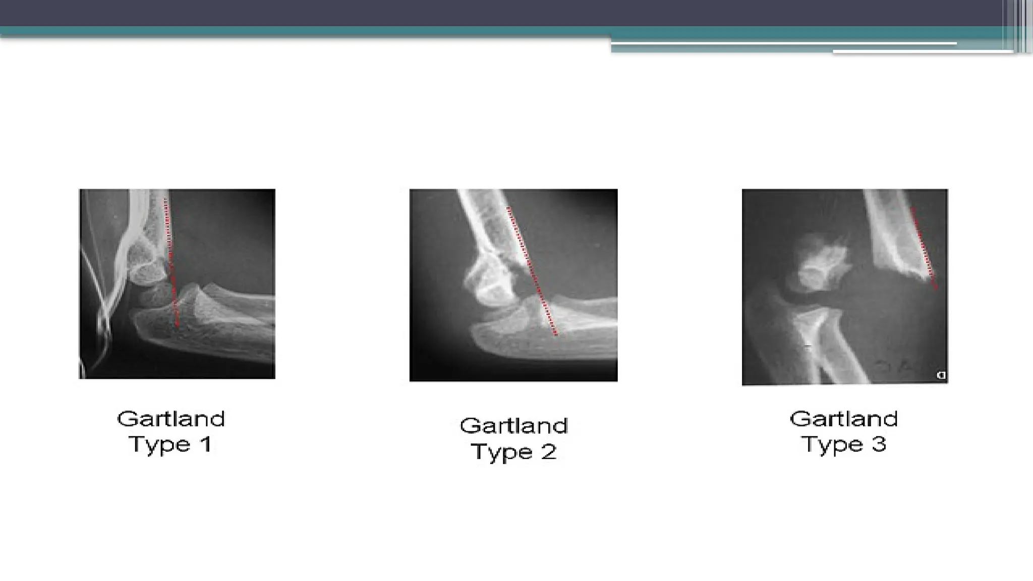 Paediatric Fractures and Management.pptx