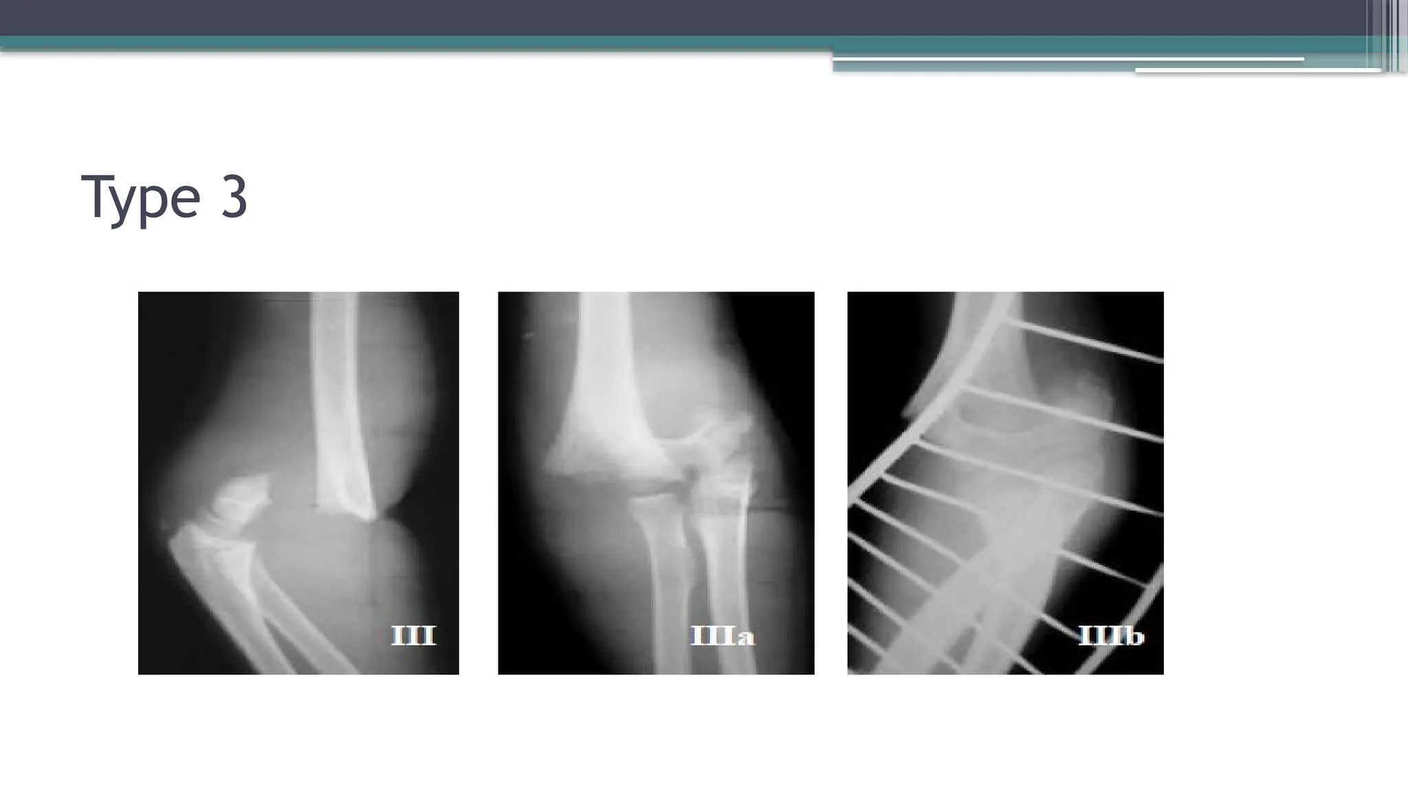 Paediatric Fractures and Management.pptx