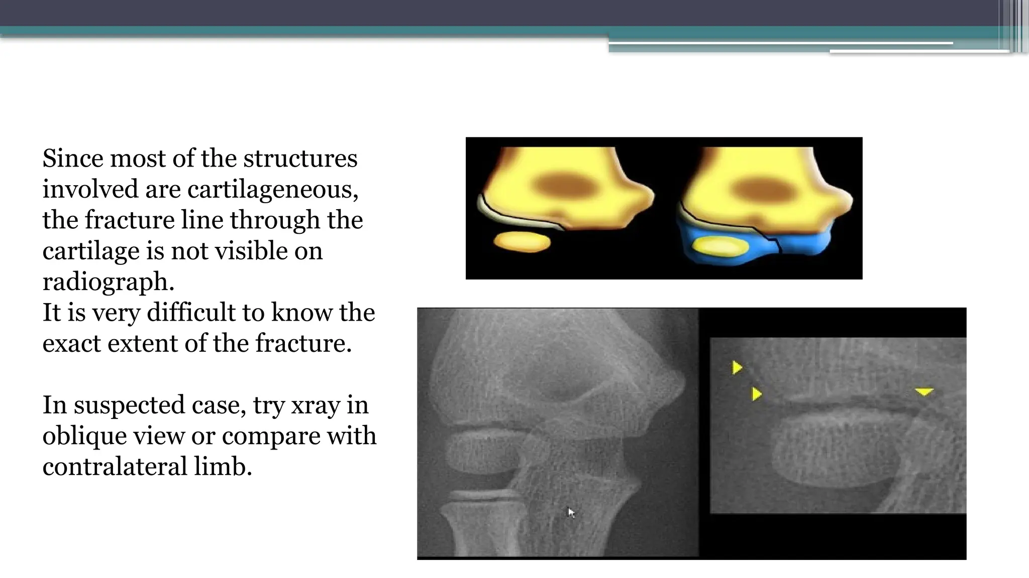 Paediatric Fractures and Management.pptx