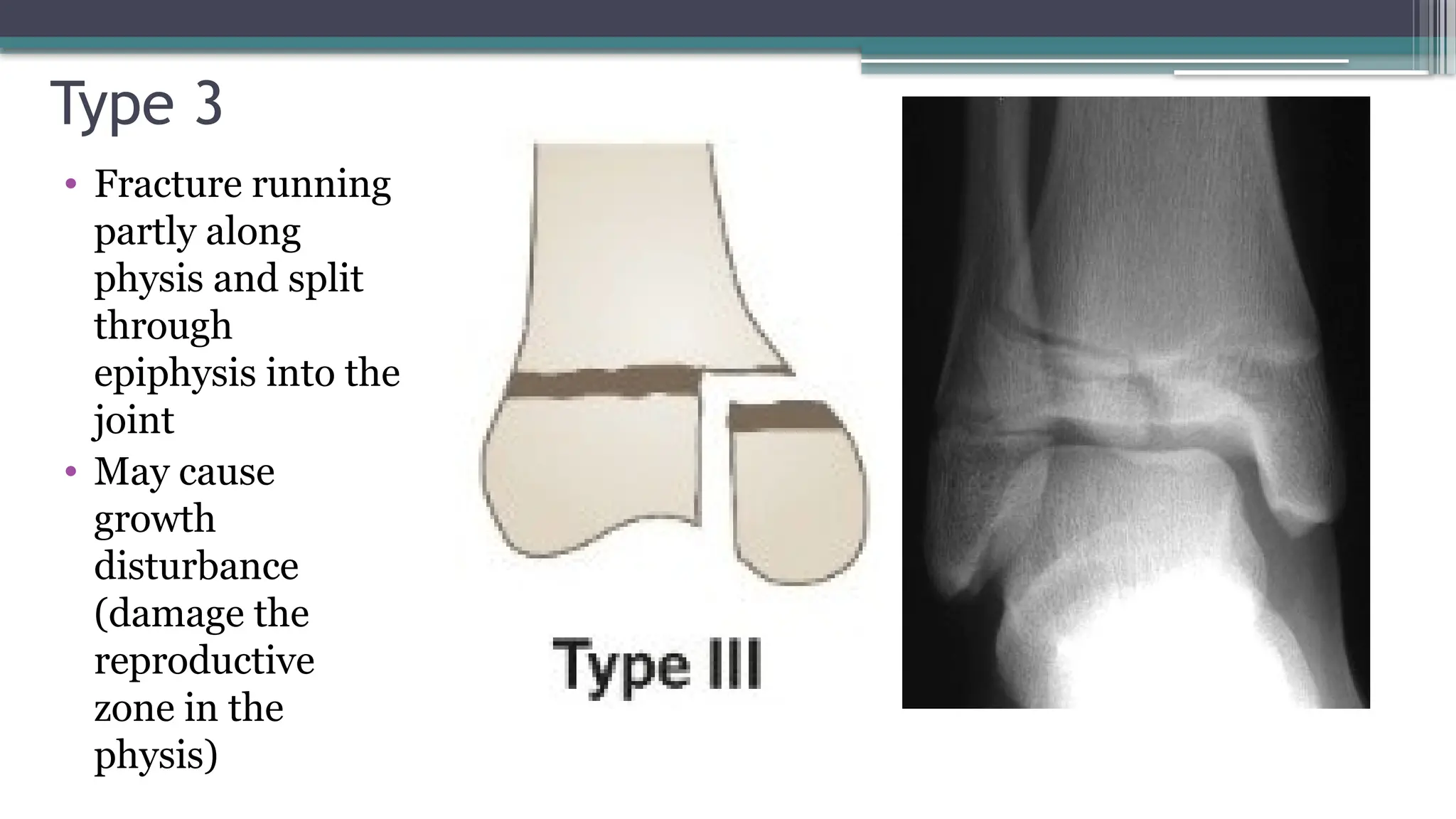 Paediatric Fractures and Management.pptx
