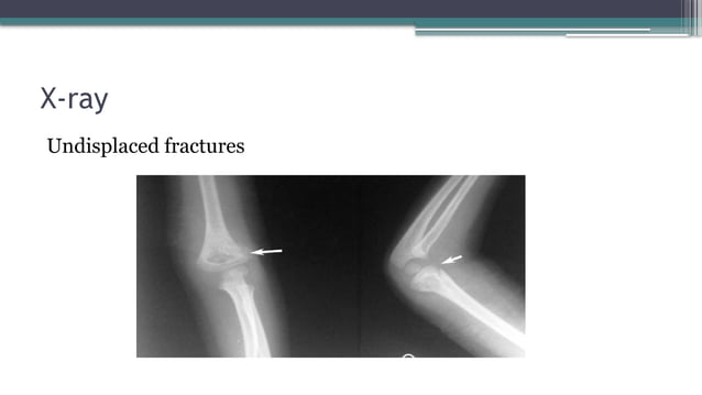 Paediatric Fractures and Management.pptx