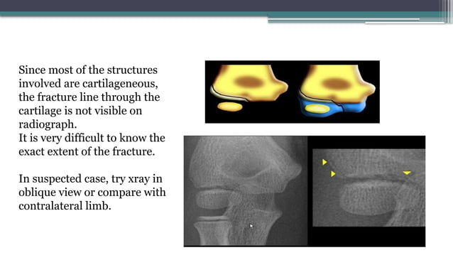 Paediatric Fractures and Management.pptx