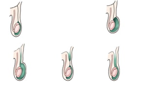 PAEDIATRIC HERNIA & HYDROCELE. pptx | PPTX